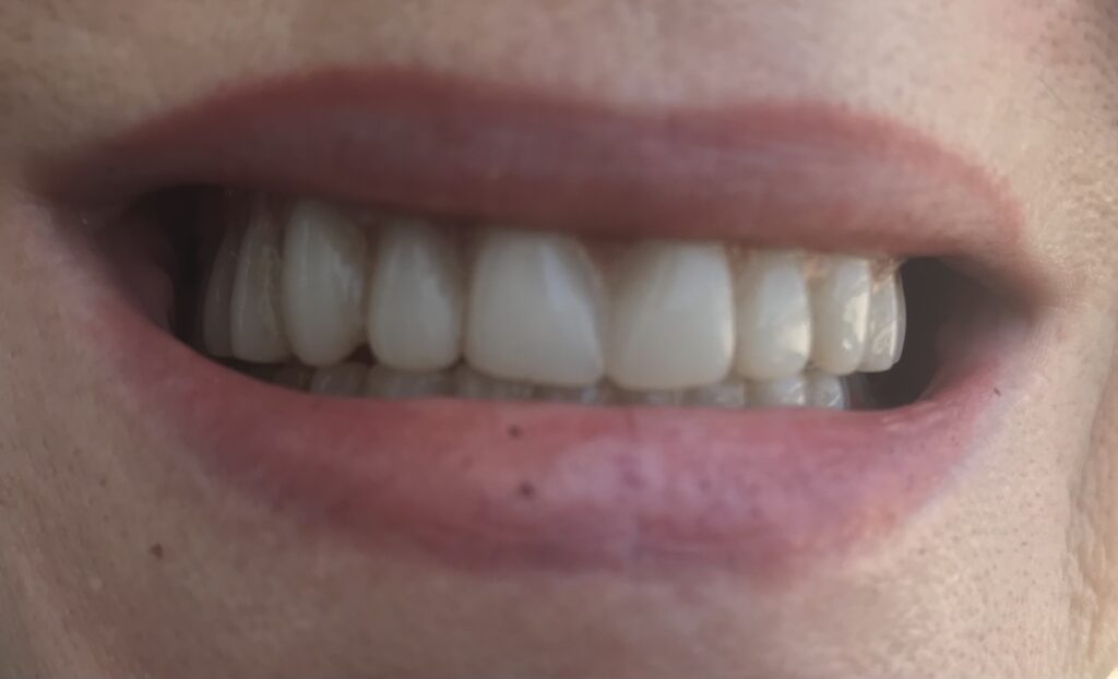 Easy Denture Set - Top and Bottom Dentures